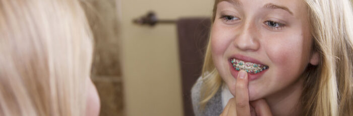 Dealing With Loose Brackets: 3 Easy Steps | Smile Doctors