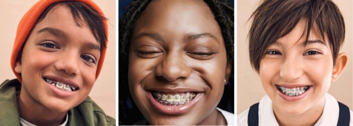 Traditional Metal Braces | Smile Doctors